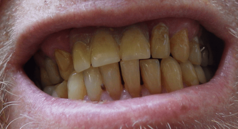 Manchas en los dientes: Causas y Tratamientos de tinciones