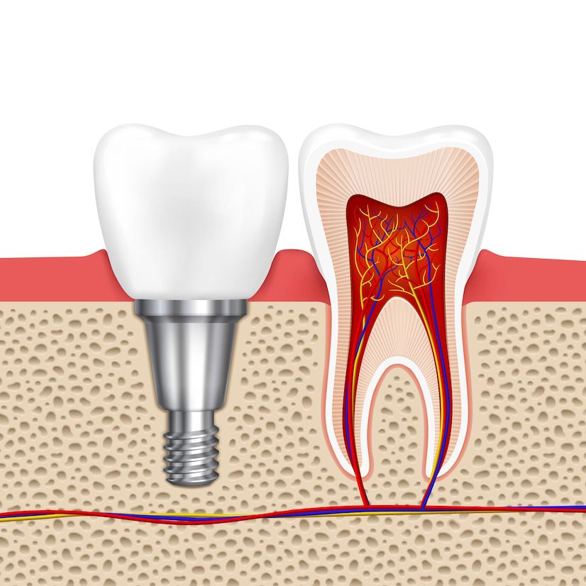 Todo lo que tienes que saber sobre los abscesos dentales - Ortoinvisible